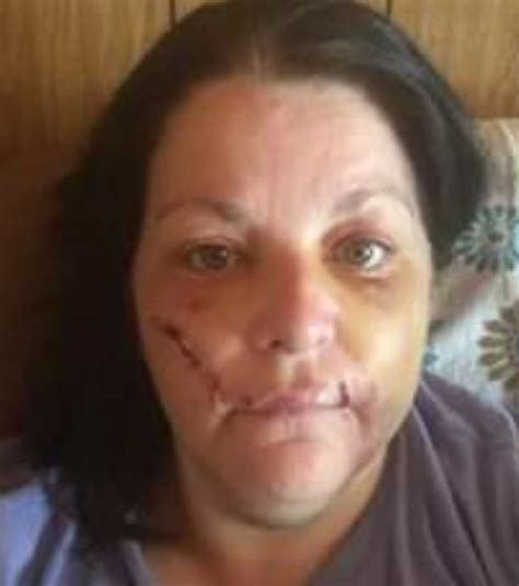 My Sex Mad Swinger Toyboy Hit Me Like A Punchbag Slit My Face And Left Me For Dead When I