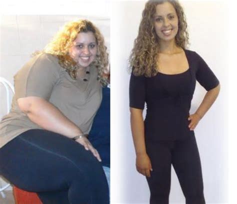 List 95 Pictures Orlistat Before And After Pictures Updated