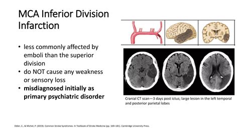 Mca And Aca Syndromes Pptx