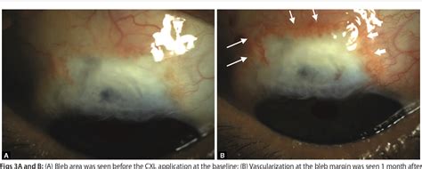 Figure 3 From Collagen Crosslinking Assisted Treatment Of A Bleb Leak