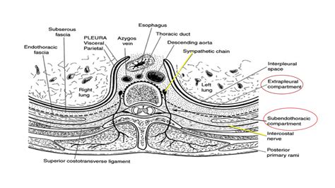 Paravertebral Block Pptx Anesthetic Consideration Ppt