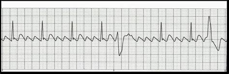 Various Rhythms With Multifocal Pvcs