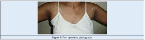 Rare Case Of Bilateral Accessory Axillary Breasts A Case Series