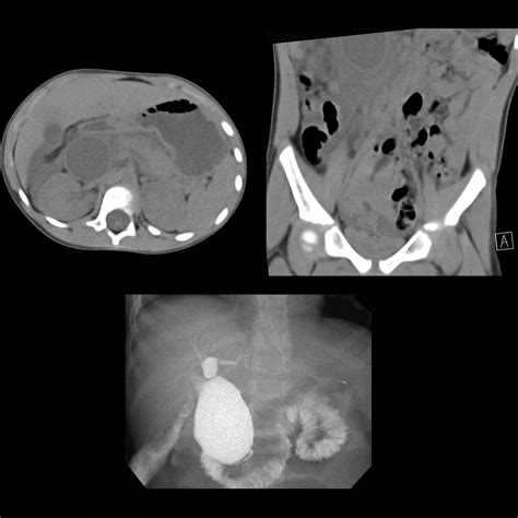 Choledochal Cyst Pediatric Radiology Reference Article Pediatric