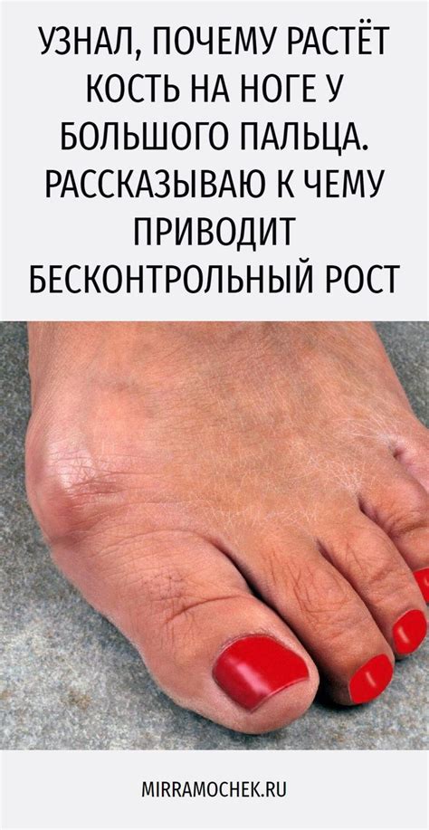 Узнал почему растёт кость на ноге у большого пальца Рассказываю к чему приводит Ноги