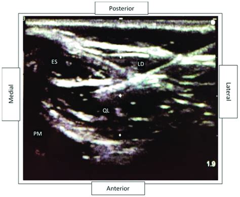 Ultrasound Of Block Administration Plan Ql Quadratus Lumborum
