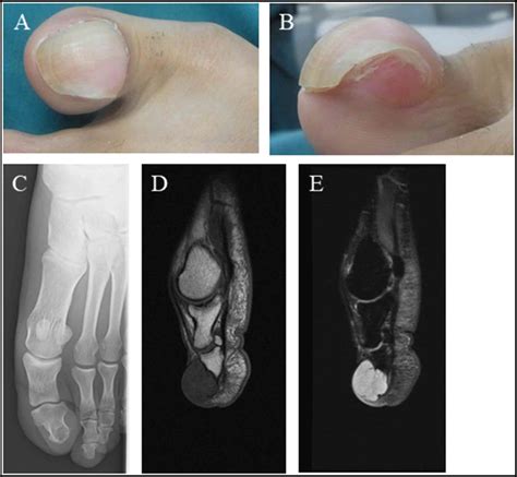 Glomus Tumor Toe