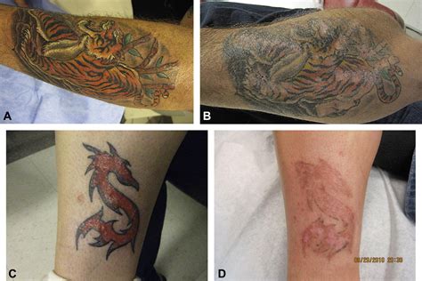 The City Of Crochet View 17 What Does Tattoo Ink Rejection Look Like