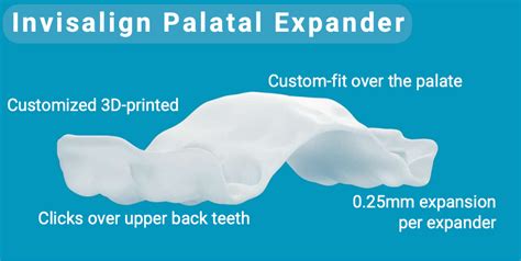 Palatal Expanders Mybracesclinic