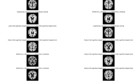 Detecting Alzheimers With Deep Learning Step By Step Guide