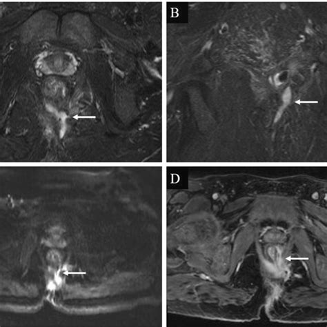 An Intersphincteric Perianal Fistula With Abscess In A 47 Year Old Man