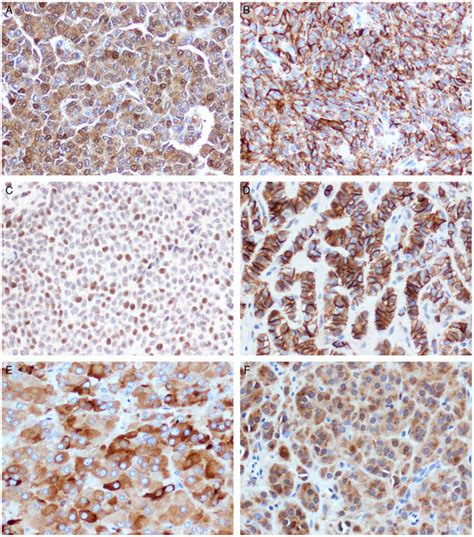 Ihc Stains Of Primary Gct Showing High Mitoitc Index And High