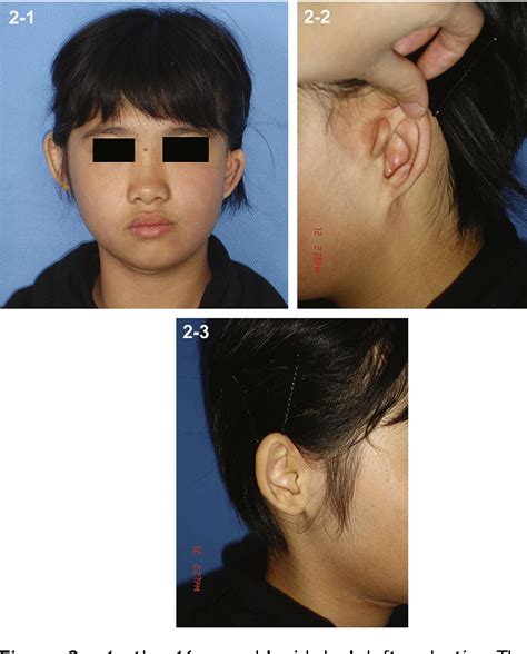 Accessory Auricle Of Ear Semantic Scholar