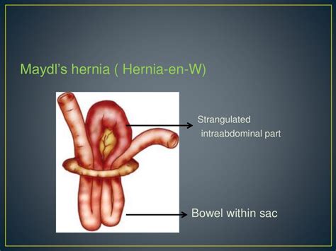 Inguinal Hernia Ppt