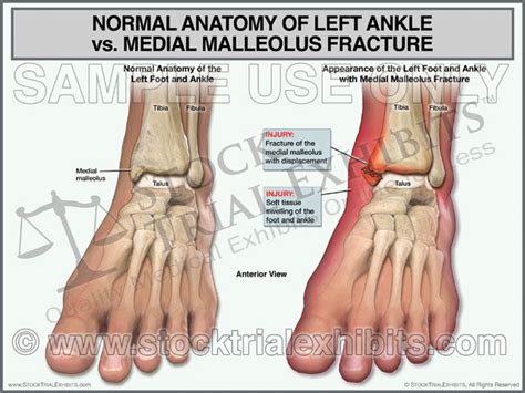 Ankle Anatomy Normal Vs Medial Malleolus Fracture Of Left Ankle Stock