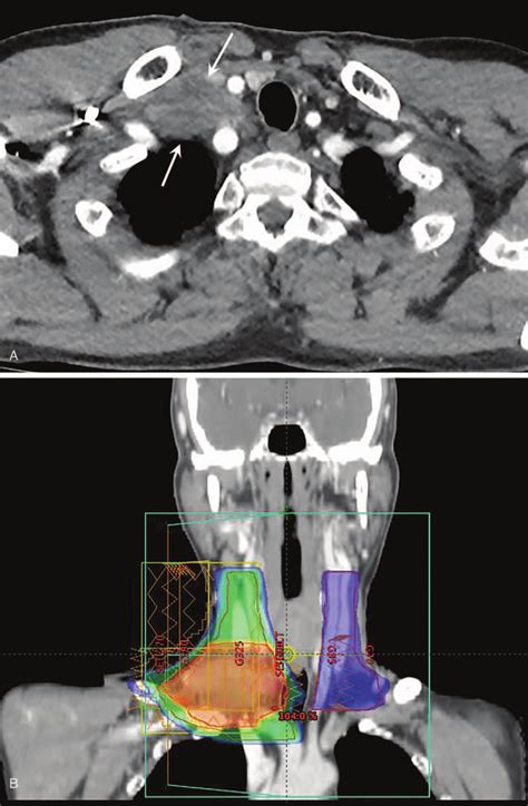 A Contrast Enhanced Chest Ct Obtained At The Level Of Thoracic Inlet Download Scientific