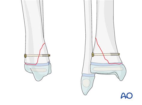 Open Reduction Screw Fixation For Epiphysiolysis With Metaphyseal Wedge Salter Harris Ii Of