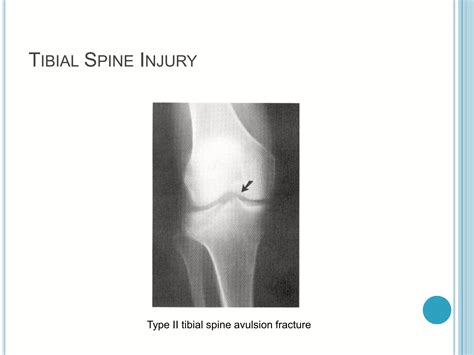 Proximal Tibia Fracture Pptx