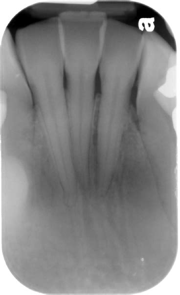 Vascular Nutrient Canals Dr Gs Toothpix