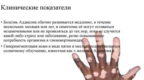 Болезнь Аддисона презентация онлайн