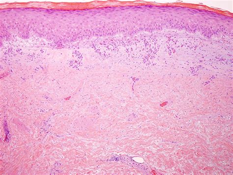 Paraneoplastic Scleroderma Morphea Dermatopathology