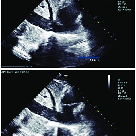 Cvp Range Wise Correlation Between Cvp And Rv Ivcd Download Scientific Diagram