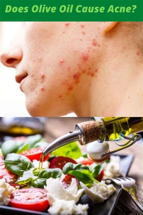 Does Olive Oil Cause Acne