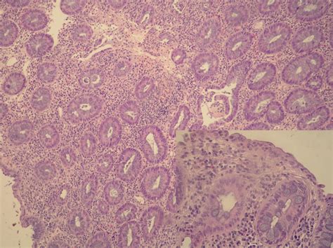 Colon Mucosa Distortion Of Crypt Architecture Inflammation Of Crypts