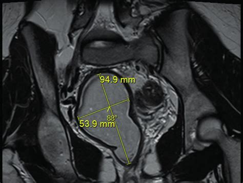Distal Vaginal Agenesis Prolékaře Cz