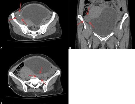 Right Ovary Visualized By Ct And Not Seen On Ultrasound A 56 Year Old