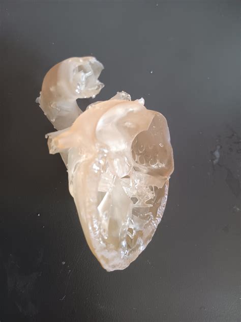 Atrioventricular Septal Defect Human Steam