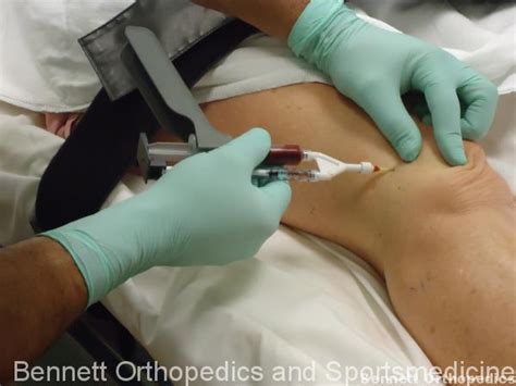 Tampa Stem Cell Knee Cartilage Repair Sarasota St Petersburg Venice