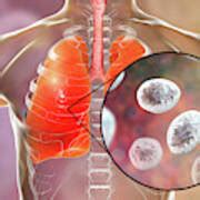 Pneumocystis Pneumonia Photograph By Kateryna Kon Science Photo