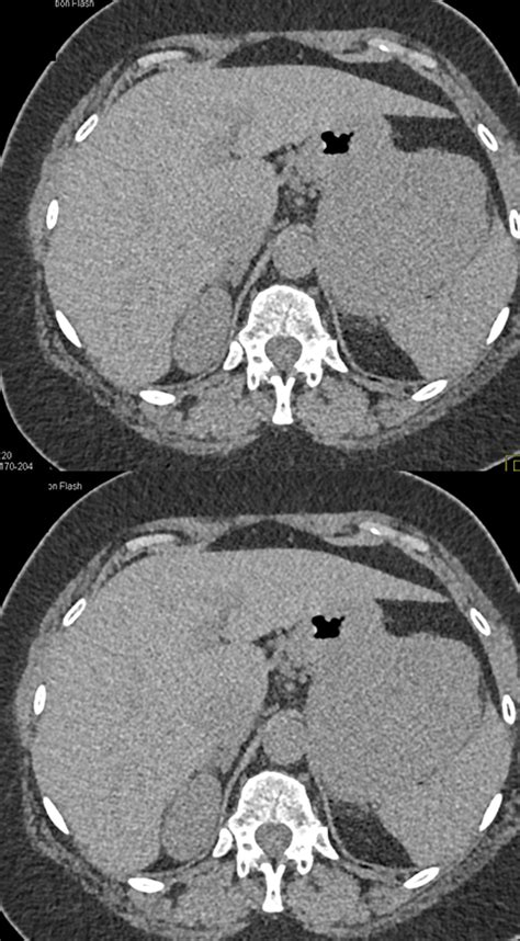 Gastrointestinal Learning Modules Ct Scanning