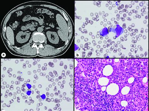 A Abdominal Computed Tomography Images Obtained On The Day Of Admission