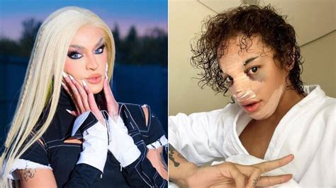 Pabllo Vittar exibe olho roxo e curativo após plástica no nariz veja