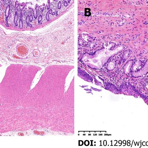 Microscopy Of The Specimen With Hematoxylin And Eosin Staining A