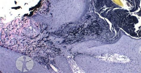 Elastosis Perforans Serpiginosa Pathology Image