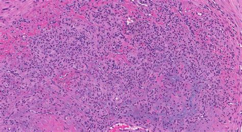 Glomus Tumour Atlas Of Pathology