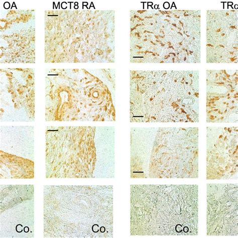 Synovial Cells Positive For Deiodinase 1 Dio1 The Thyroid Hormone Download Scientific