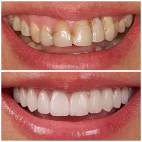 Veneer Fitzroy Dental