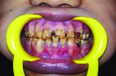 Clinical Appearance Of Teeth Download Scientific Diagram