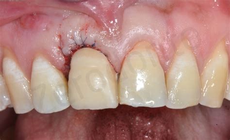 Socket Preservation Zerodonto Dentistry In Blog