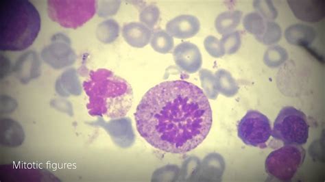 Megaloblastic Anemia 15 12 2015 Youtube