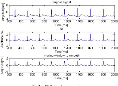 Figure 2 From P Wave Detection And Delineation Based On Distances Transform Semantic Scholar