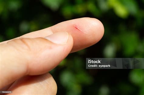 여자는 집게 손가락과 흉터 피부를 손으로 자르고 매크로 쇼트 아시안 바디 스킨 파트 헬스케어 컨셉 보 케 그린 가든 배경 상처에 대한 스톡 사진 및 기타 이미지 Istock