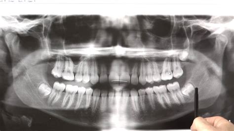 Types Of Impacted Wisdom Teeth