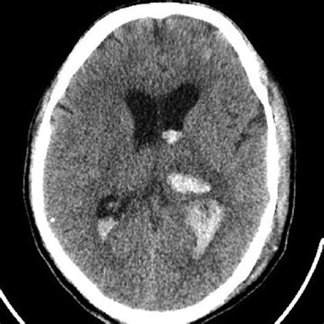 Computed Tomography Brain At Admission Showing Thalamic And