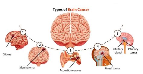 Brain Tumors Causes Types Symptoms And Treatment
