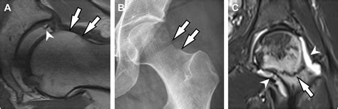 Femoroacetabular Impingement Magnetic Resonance Imaging Clinics